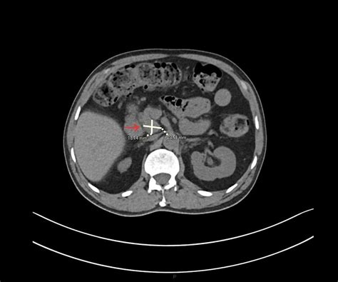 Ct Abdomen Peri Pancreatic Lymph Nodes Arrow On Initial Ct Scan Download Scientific Diagram