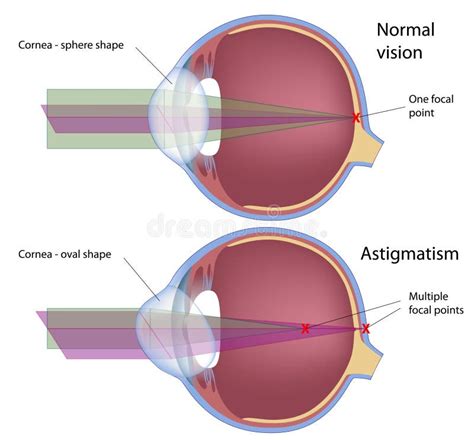 Vision Defects Myopia Hyperopia And Astigmatism Stock Vector Illustration Of Human Lens