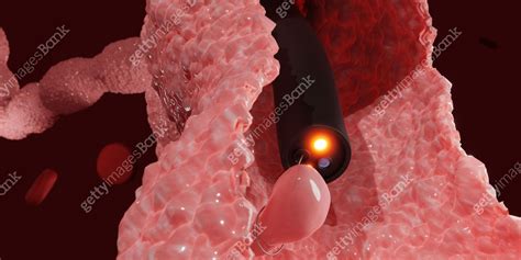 Colon Polyp Removal Endoscope Inside Colonoscopy For Colon Polyps Search 3d Render 이미지