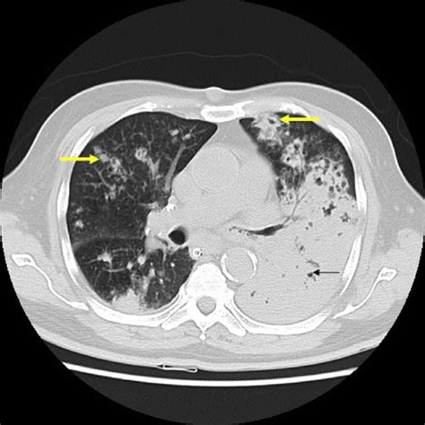 Bilateral Nodular Radio Opacities With Large Coalescent Region In Left Download Scientific
