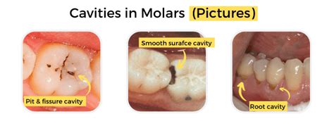 Molar Cavities