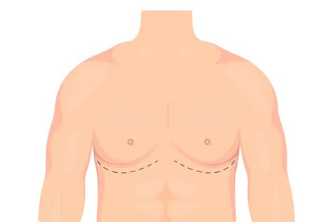 Gynecomastia Vs Pseudogynecomastia Whats The Difference