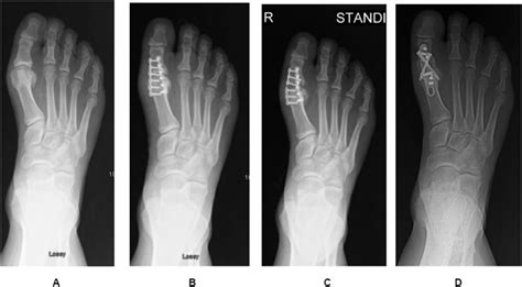 Arthrodesis Of First Metatarsophalangeal Joint Onxorx