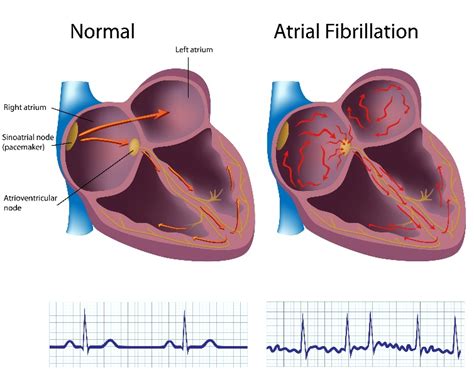 Atrial Fibrillation And Other Rhythm Disorders Connected Cardiology