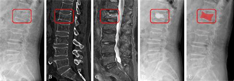 Figure 4 From Exploring Deep Learning Radiomics For Classifying Osteoporotic Vertebral Fractures