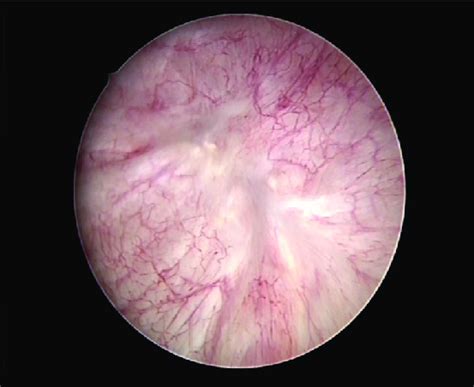 Bladder Incision Scar Under Cystoscopy Posttrlrnu Trlrnu Total