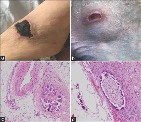 Calciphylaxis Skin Histology