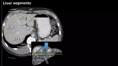 Liver Segment Anatomy Ct Scan Pptx