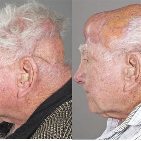 Pdf Total Scalp Excision And Reconstruction Using A Free Omental Flap