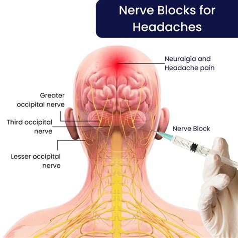 Nerve Block For Headaches In Brooklyn Nyc And Nj Occipital Nerve Block