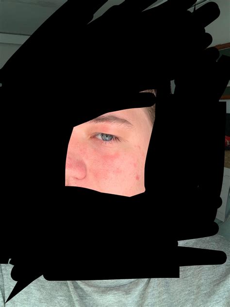 Rash On Face Rhiv