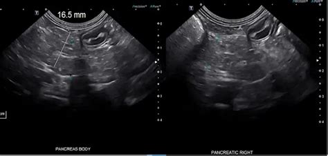Chronic Pancreatitis In Dogs Diagnosis And Management