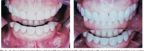 Figure From Planning Restorative Treatment For Patients With Severe Class II Malocclusions