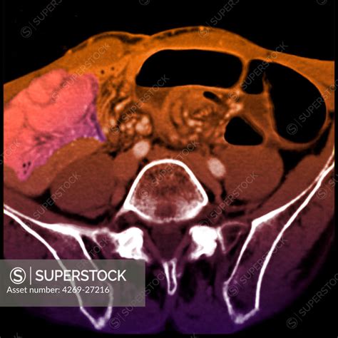 Intestinal Obstruction Colored Enhanced Axial Computed Tomography Ct Scan Of The Abdomen