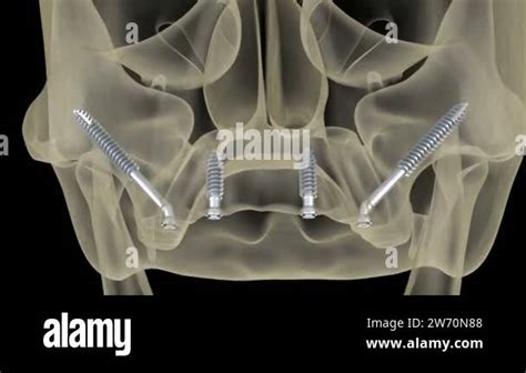 Maxillary Prosthesis Supported By Zygomatic Implants Medically