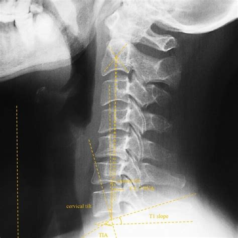 Risk Factors For Cervical Disc Degeneration Multiple Logistic