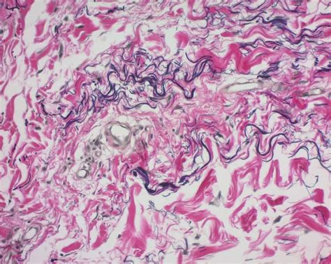 Elastic Stains Normal Skin