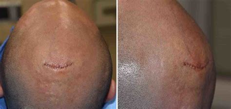 Plastic Surgery Case Study Posterior Sagittal Crest Reduction Through