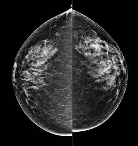 Radiopaedia Case Breast Mass Bi Rads 4 Id 170816 Study 138115 Nc