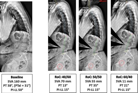 Different Manners Of Closing The Osteotomy Wedge Using Surgical