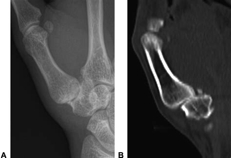 Minimally Invasive Thumb Carpometacarpal Joint Arthrodesis With