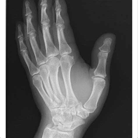 An Incision Is Made At The Dorsal Thumb Metacarpal Bone Download Scientific Diagram