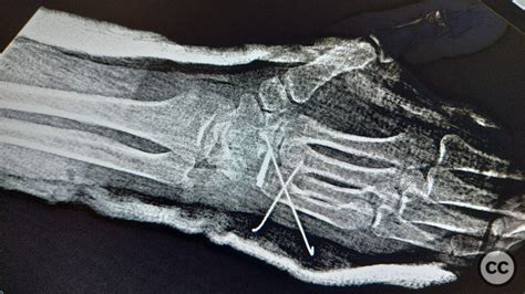 Hamate Fracture Plus 4th 5th Carpometacarpal Dislocations