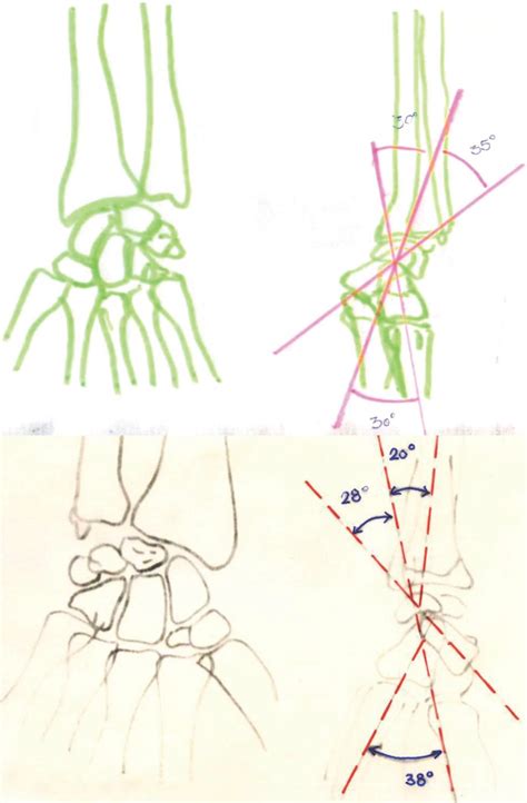 28 Years After Mattirisse Scaphoid Bone Surgery Asymptomatic “disi