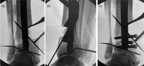 Early Results Of Intramedullary Nail Fixation In Distal Tibia Oblique