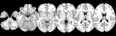six representative axial slices showing the foci resultant from the