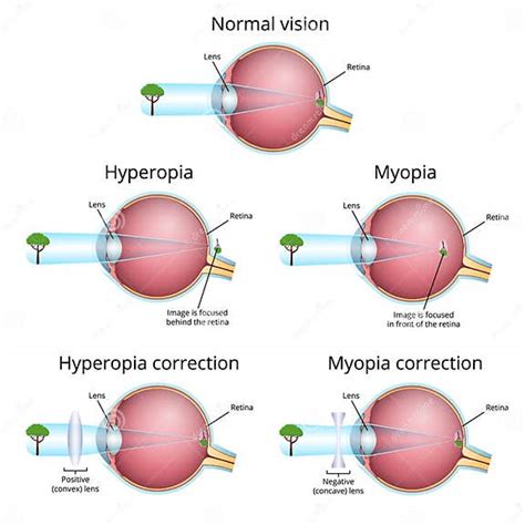 Vision Problems And Their Correction Myopia And Hyperopia Stock