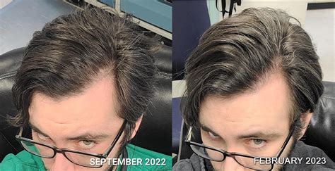 Another Update Almost A Year On Dutasteride And Oral Minoxidil After