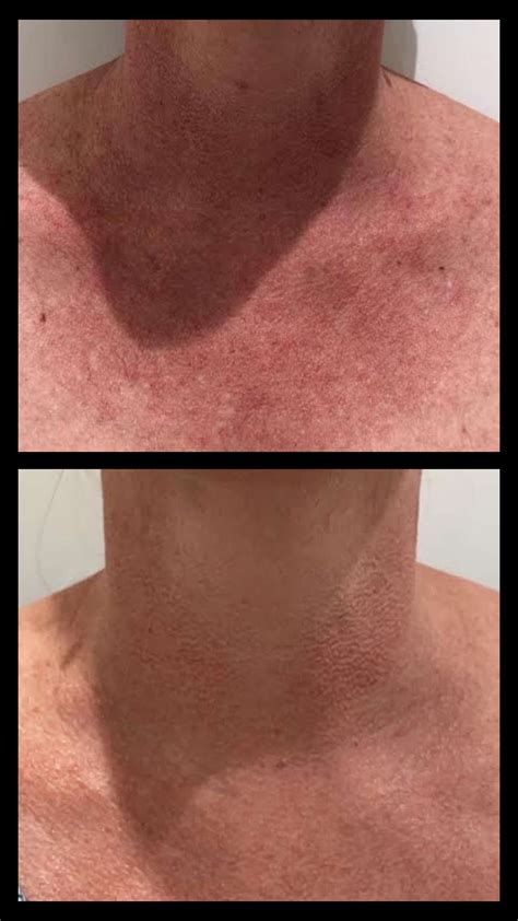 Pico Genesis FX Integrity Skin