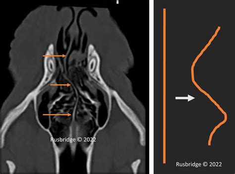 Nasal Septum Deviation Cavalier Matters