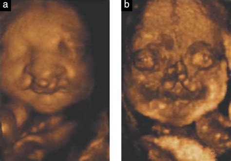 Ultrasound Antenatal Diagnosis Of Cleft Palate By A New Technique The