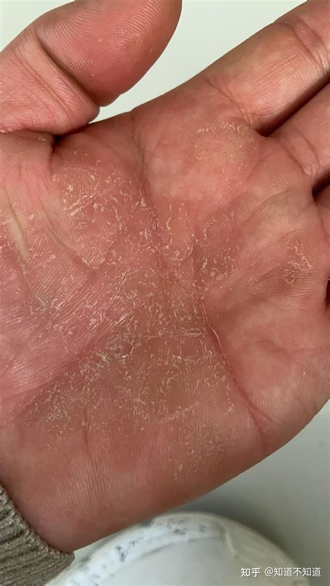 手癣和湿疹的区别 知乎
