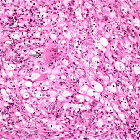 Xanthogranulomatous Pyelonephritis Morphology