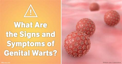 What Are The Signs And Symptoms Of Genital Warts