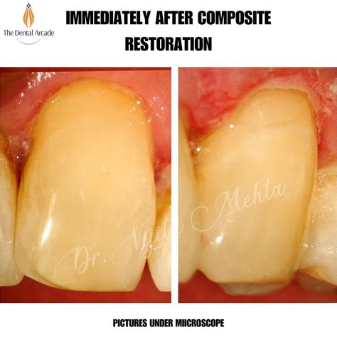 Composite Restoration The Dental Arcade Blog