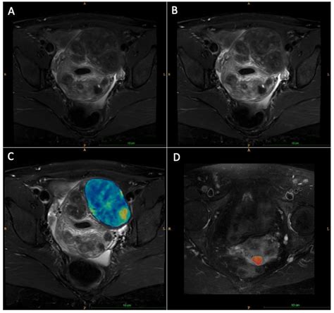 Developing A Machine Learning Based Clinical Decision Support Tool For Uterine Tumor Imaging