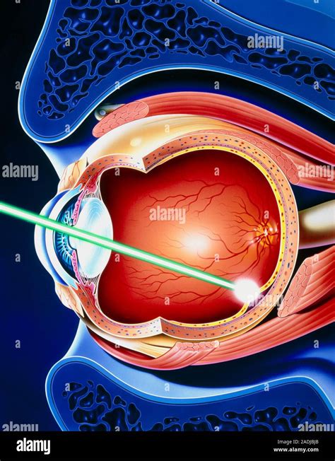 Laser Surgery On The Retina Artwork Showing Laser Surgery On A