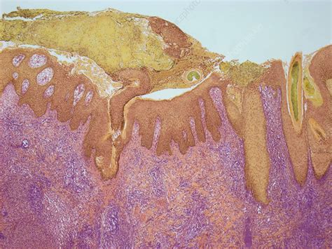 Ringworm Light Micrograph Stock Image C021 6164 Science Photo Library