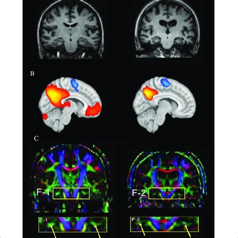 The Analysis Of The Neuroimaging Data Download Table