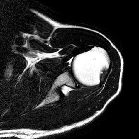 The Stanmore Classification System Of Shoulder Instability Download