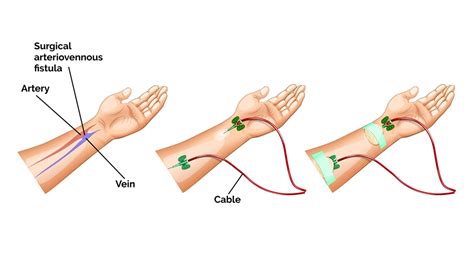 Advanced Interventional Nephrology For Vascular Access