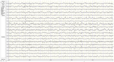 EEG Montages Part Pros And Cons
