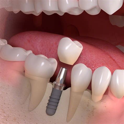 Single Tooth Implant Restoration — Apco Dental Care