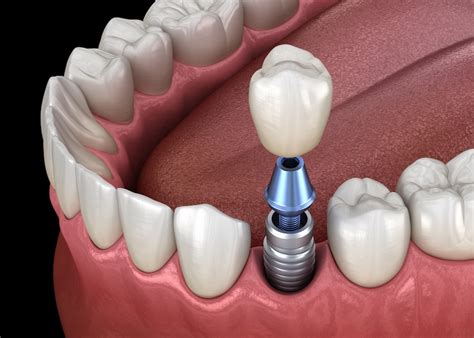 How Long Do Dental Implants Last Dental Blog Bellevue Dental Oasis