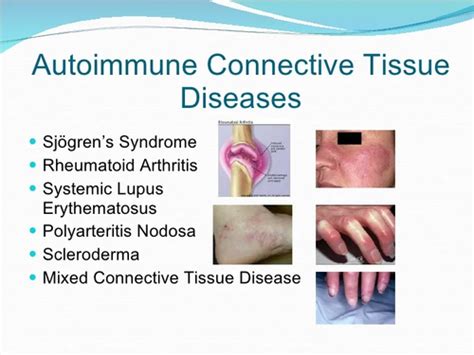 Connective Tissue Diseases Flashcards Quizlet