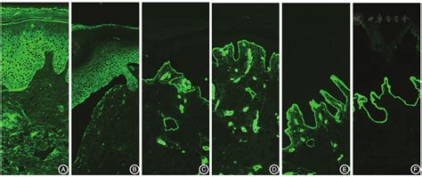 Comparison Of Immunofluorescence Mapping And Immunohistochemistry In The Auxiliary Diagnosis Of